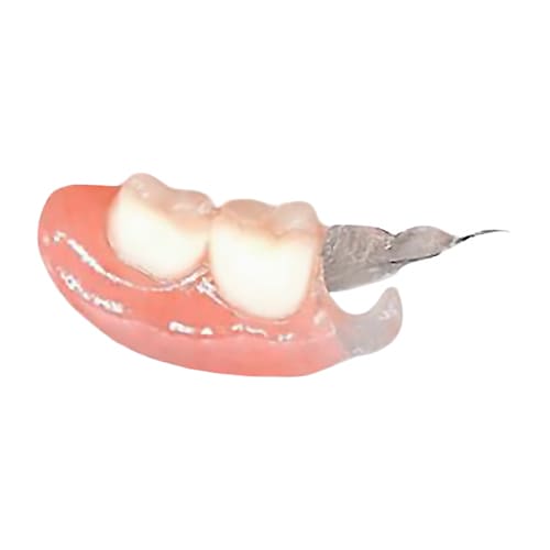 Prótesis dental acrílica completa inferior en muñón de Locator ...